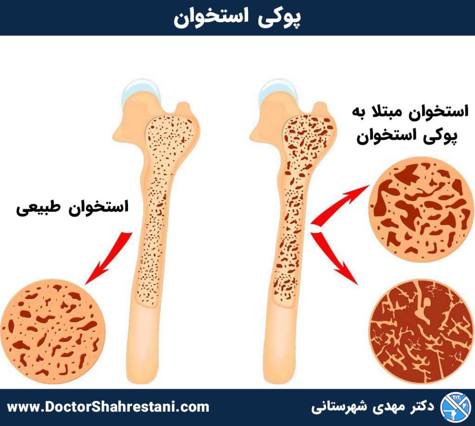 پوکی استخوان، علائم، پیشگیری و راههای درمان